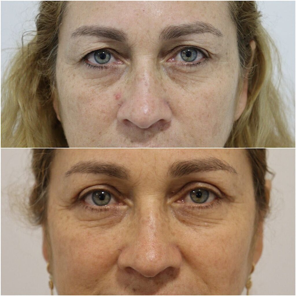 Blefaroplastia o Cirugía de Párpados - Doctores Pulido IPS